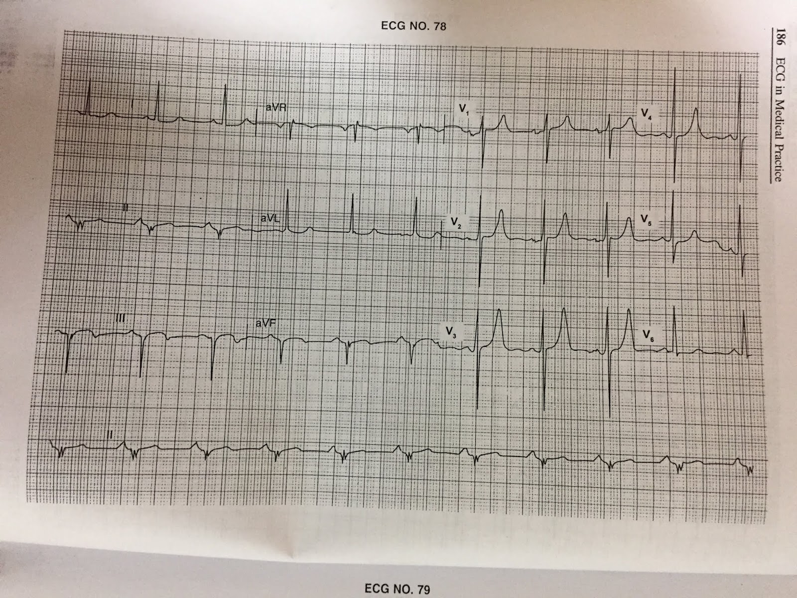 ECG EXERCISE 75,76,77,78