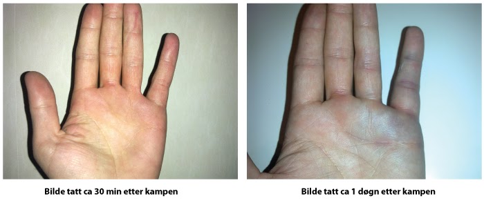 Min blogg om utskeielser i hverdagen:): Broken finger - Spring season over
