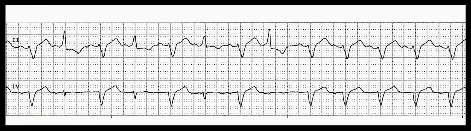 Various Bigeminal PVCs