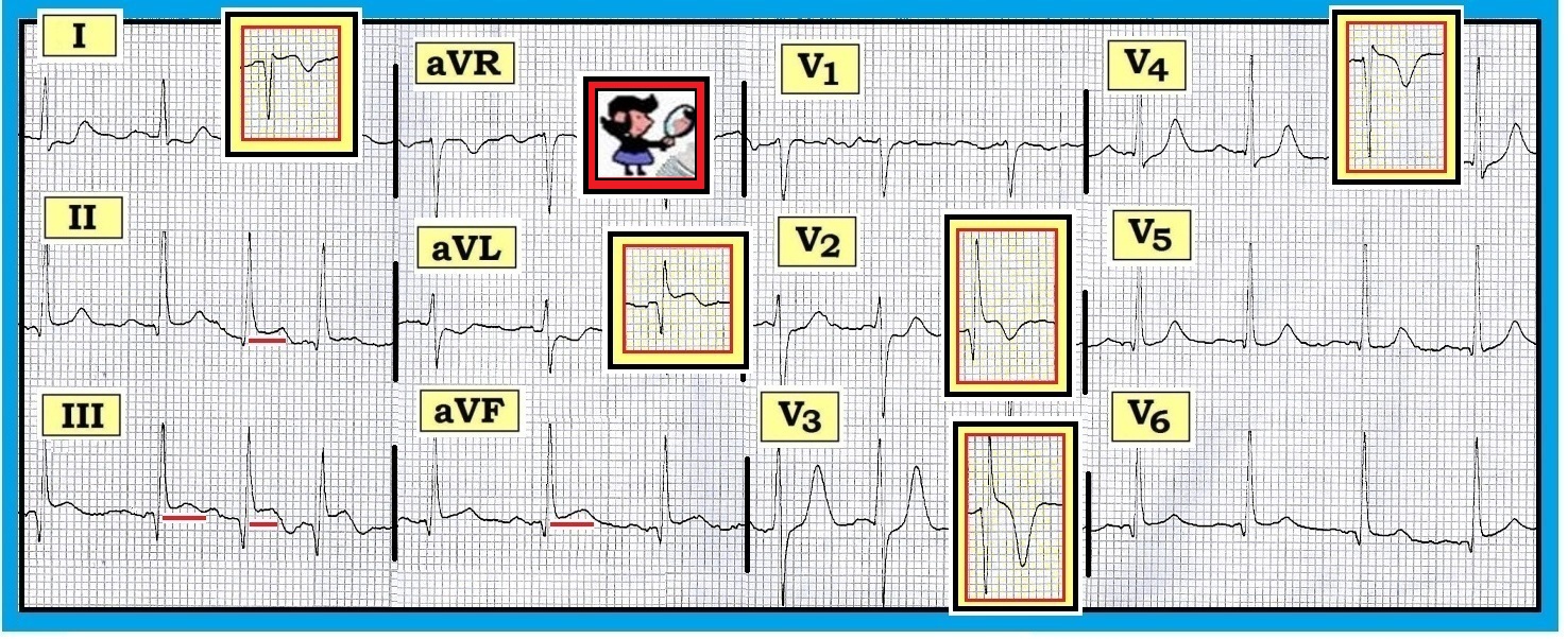 ECG Interpretation: ECG Interpretation Review #43 (AFib - PACs - Acute ...