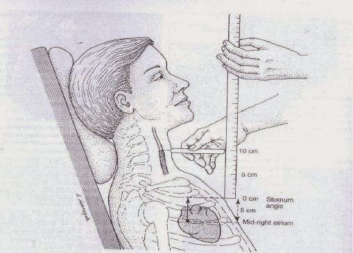 CARA MENGUKUR JVP (JUGULARIS VENOUS PRESSURE/TEKANAN VENA JUGULARIS ...