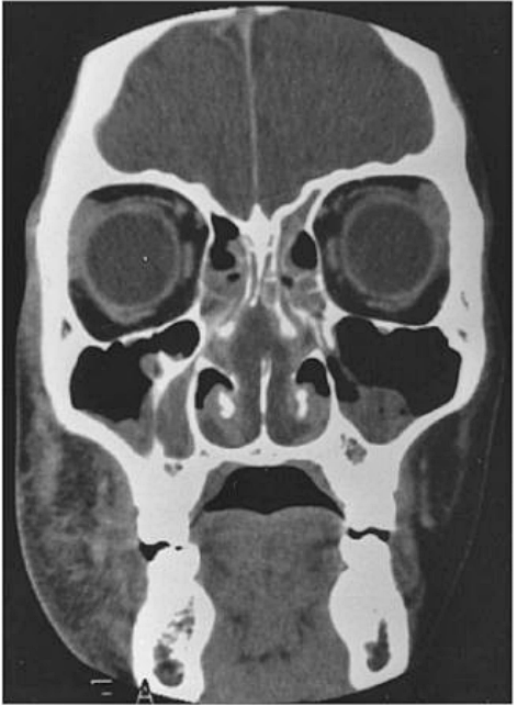lemon tea and cookies: REFERAT ABSES SEPTUM NASI