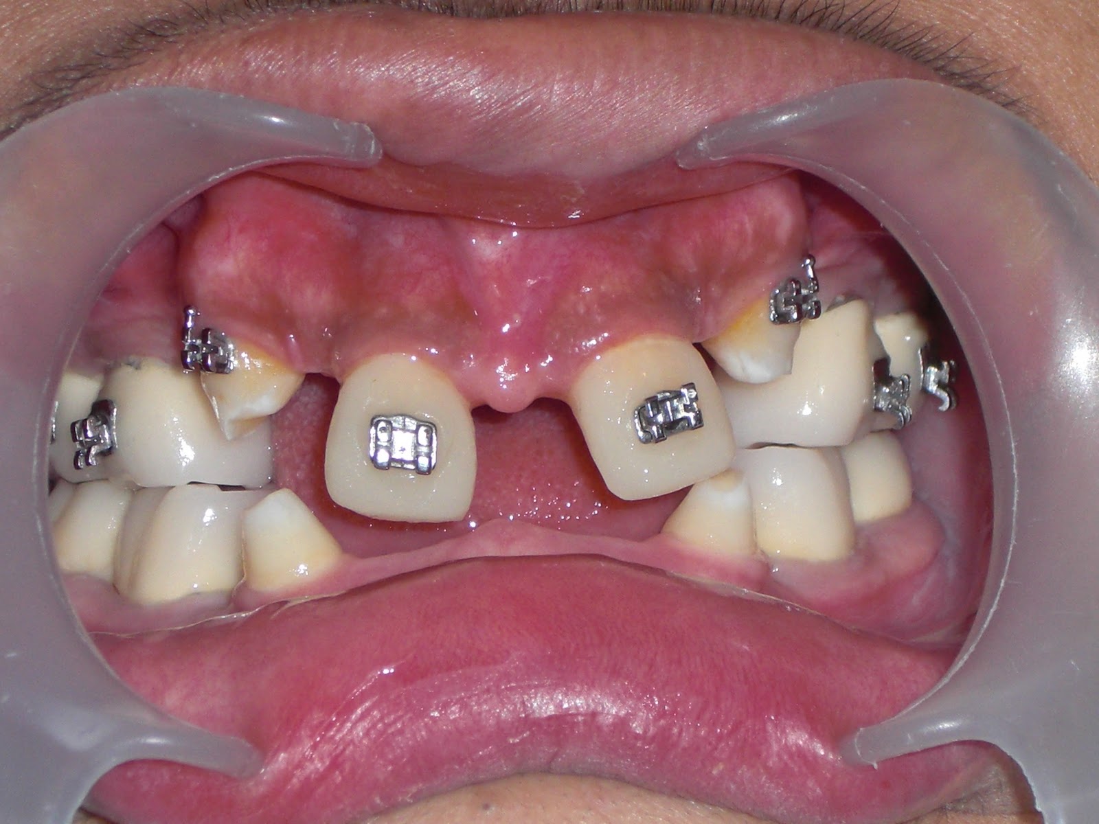 Dental Implantology: MOSTDI REPLACEMENT OF MISSING UPPER LATERALS