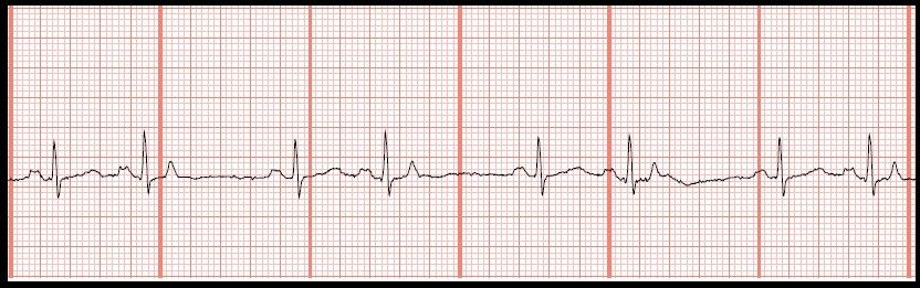 Float Nurse: Practice EKG Rhythm Strips 121