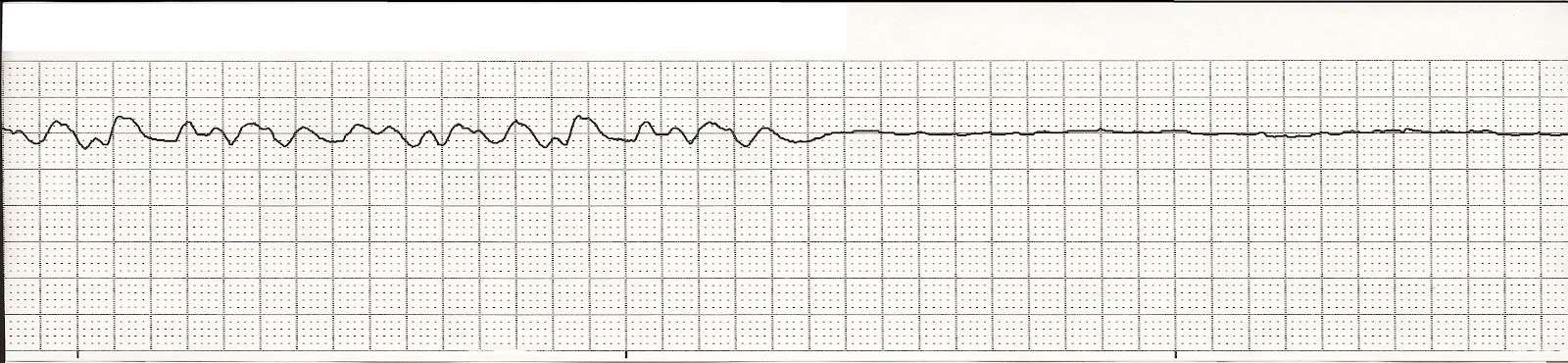 EKG Rhythm Strips 34