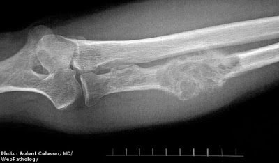 Cancer nos ossos - Sintomas e tipos de cancer no osso. - Artigos sobre ...