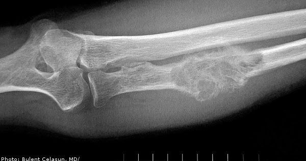 Cancer nos ossos - Sintomas e tipos de cancer no osso. - Artigos sobre ...