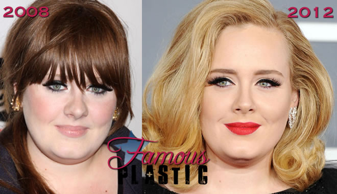 Adele Plastic Surgery Nose Job Before and After (Star plastic surgery)