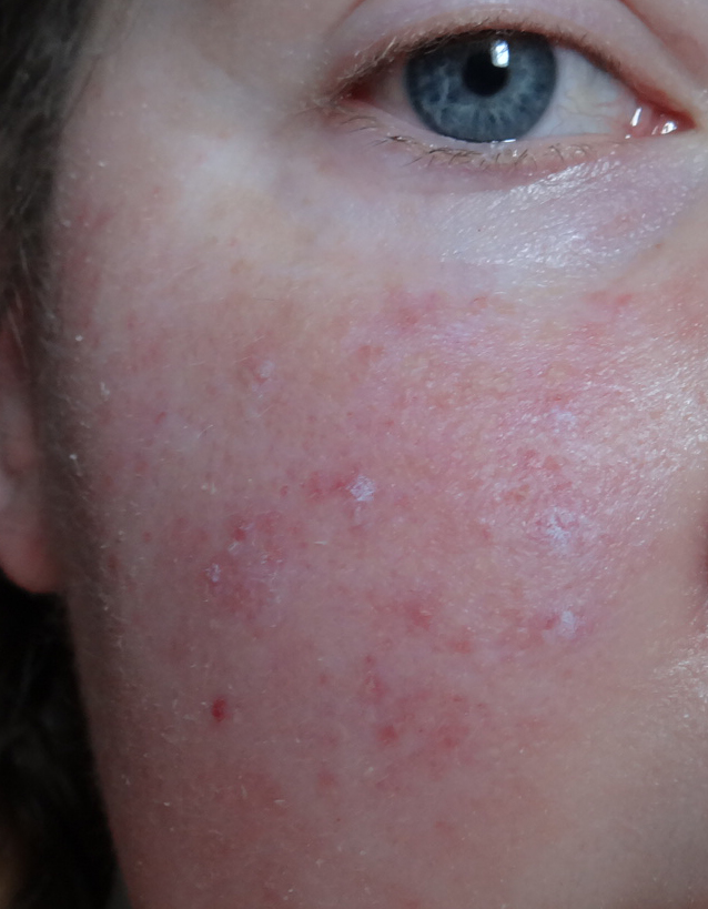 Scarlet Letters, dealing with vascular rosacea, face flushing, burning ...