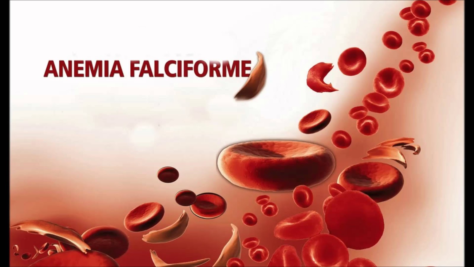 A Anemia Falciforme - Análises Clínicas.com