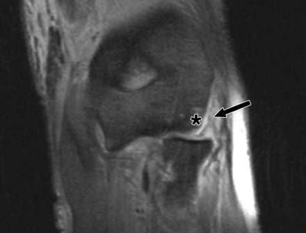 Ulnar Collateral Ligament Wrist Mri