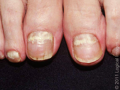 Residentes de familia en Lanzarote.: Leuconiquia.