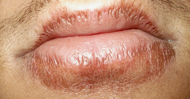 O Que Dermatite Labial Ou Eczema No L bio Sadestar o-que-dermatite-labial-ou-eczema-no-l-bio-sadestar