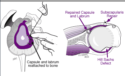 UW Shoulder and Elbow Academy: Bankart surgical repair for dislocating ...