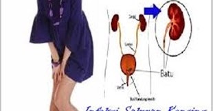 Cara Mengobati Infeksi Saluran Kencing pada Wanita - Kelas Bimbel