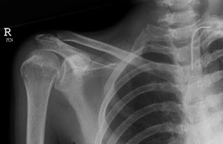 LA SALUD ESTA DENTRO DE TI: Periartritis Escapulohumeral o Periartritis ...