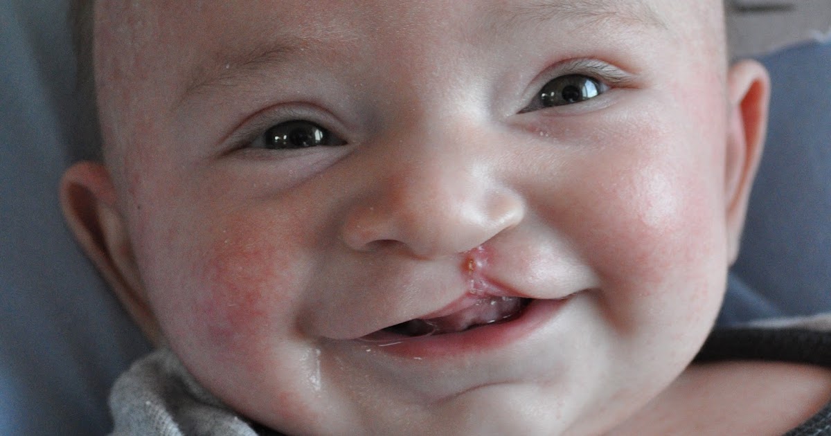 Our Cleft Story: Lip Adhesion Post-op