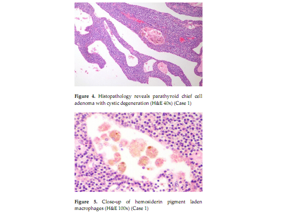 BÀI SOẠN VỀ SIÊU ÂM CHẨN ĐOÁN: CYSTIC PARATHYROID ADENOMA