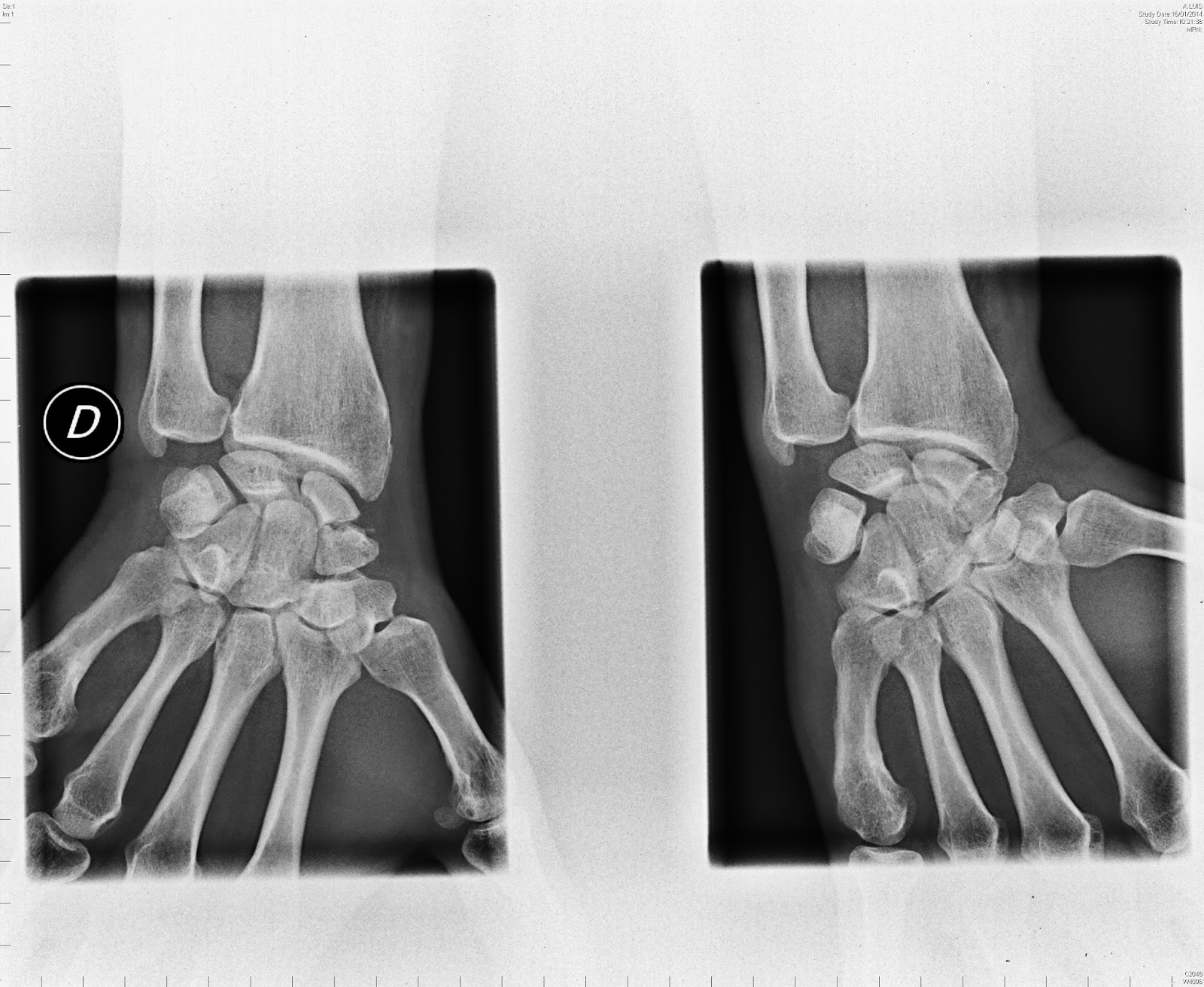 Cirugía de Mano y Traumatología: Pruebas Radiológicas para la fractura ...