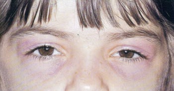 Miositis inflamatoria idiopática: Revisión sobre sus diagnósticos ...