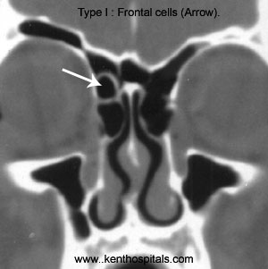 Auger Gear Image: Agger Nasi Cell Types