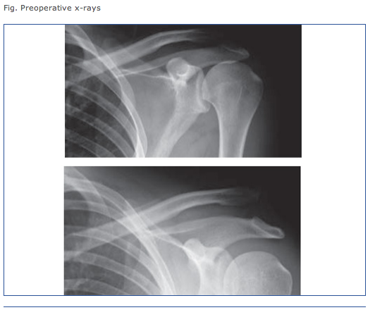 Shoulder and Elbow Surgery: "Shoulder Separation" or Collar bone ...