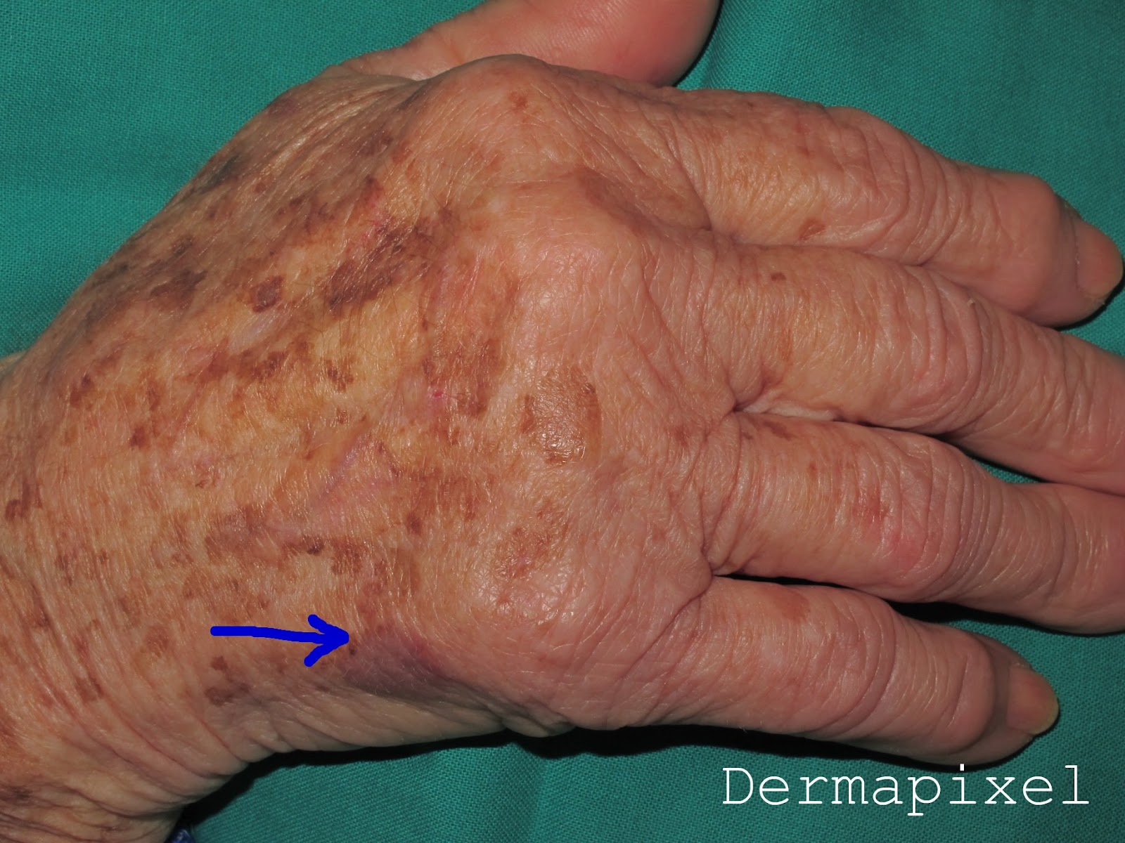 Dermapixel: Una mancha en la mano. Y un montón de especialistas