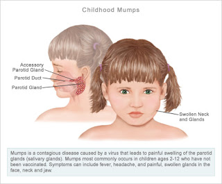 Mumps Causes, Symptoms and Treatment