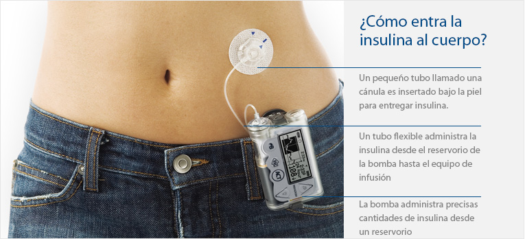 Diabetes Bariloche: La tecnología al servicio del tratamiento para la ...