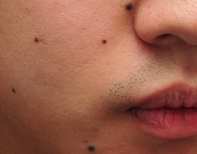 Photos of Moles on Face and Neck ~ How To Remove Moles, Warts, Skin ...