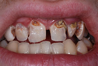Sciascia Dental: SODA POP CAVITIES