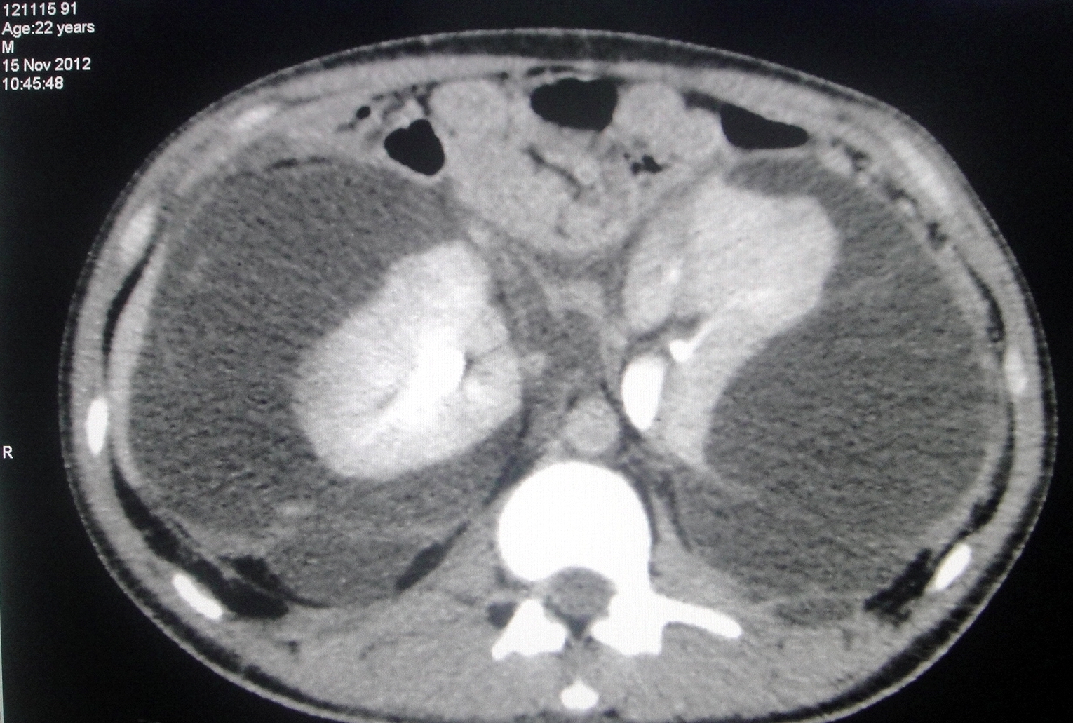 VIETNAMESE MEDIC ULTRASOUND: CASE 153: FLUID AROUND KIDNEYS of FALLOT'S ...