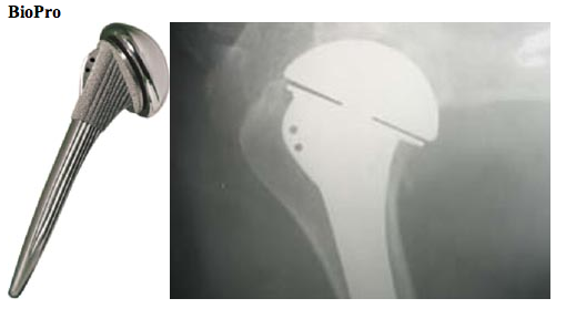 Shoulder and Elbow Surgery: Identifying the implanted shoulder ...