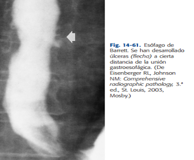 Estudios Contrastados del Sistema Digestivo: Esofagografía