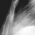 Sternal Fracture - Sternum Pain After Car Accident