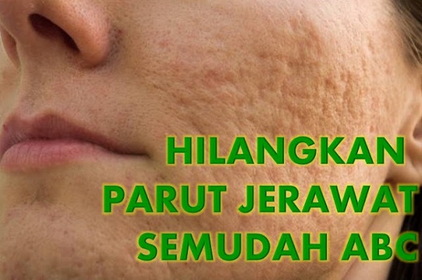 4 Cara Orang kampung Untuk Hilangkan Parut | Berita Ubed