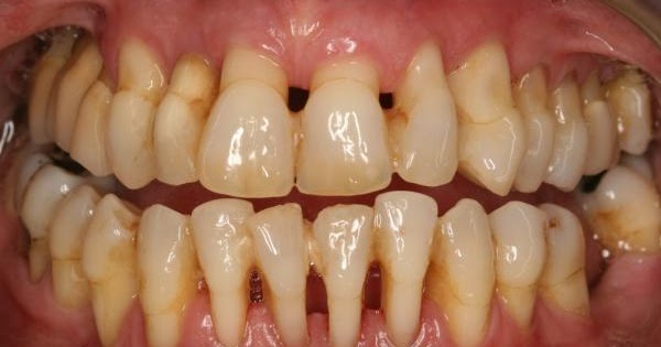 Medicina i lijek: Kako izlijeciti:PARADENTOZU -Prirodni nacin lijecenja