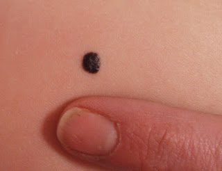 VIRTUAL GRAND ROUNDS IN DERMATOLOGY 2.0: Toddler with Black Nevus