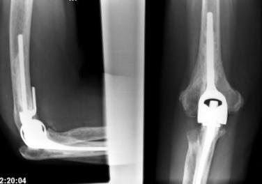 Medical Treatment Pictures-for Better Understanding: Elbow Replacement ...