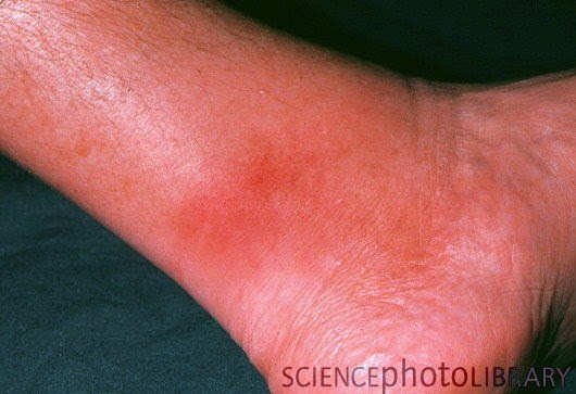 Horses and Zebras: Cellulitis and mimickers