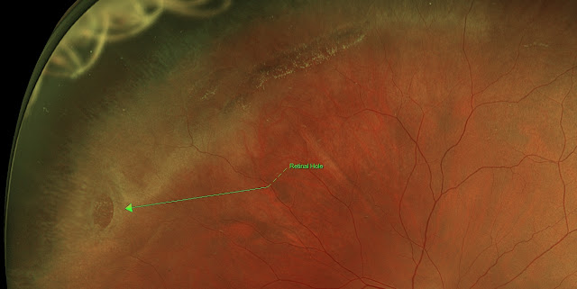 Sonoran Desert Eye Center: RETINAL HOLE AND LATTICE DEGENERATION