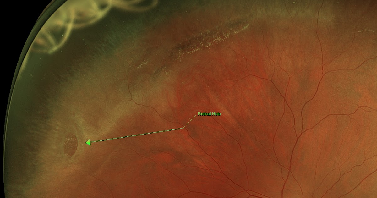 Sonoran Desert Eye Center: RETINAL HOLE AND LATTICE DEGENERATION