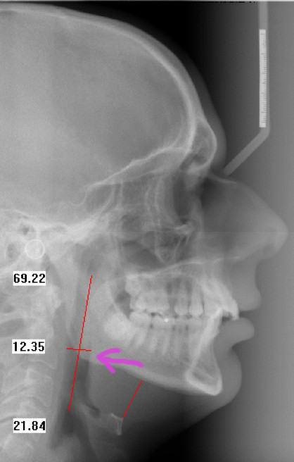 Extreme Makeover: Tom Edition: Oral Maxillofacial Surgery