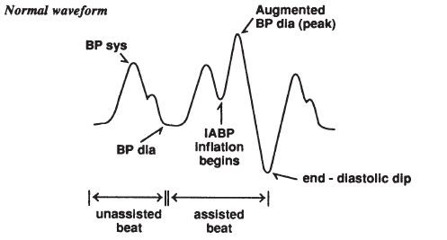 ER goldbook: IABP operation during transport