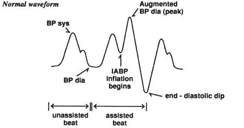 ER goldbook: IABP operation during transport
