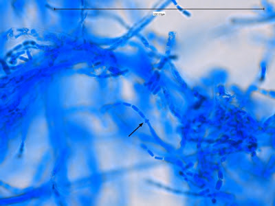 Fun With Microbiology (What's Buggin' You?): Arthrographis species