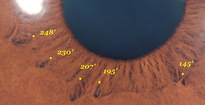 Modern & Multidimensional Iridology: Crypts, Internal Lacunae ...
