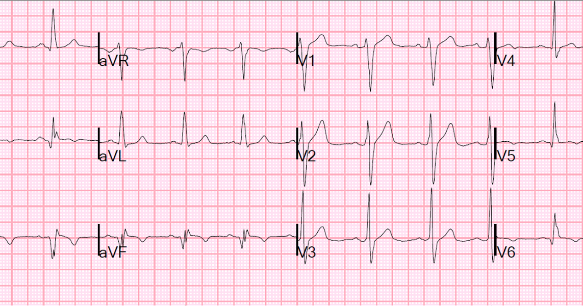 Dr. Smith's ECG Blog: Inferior MI with positive troponin: Acute STEMI ...