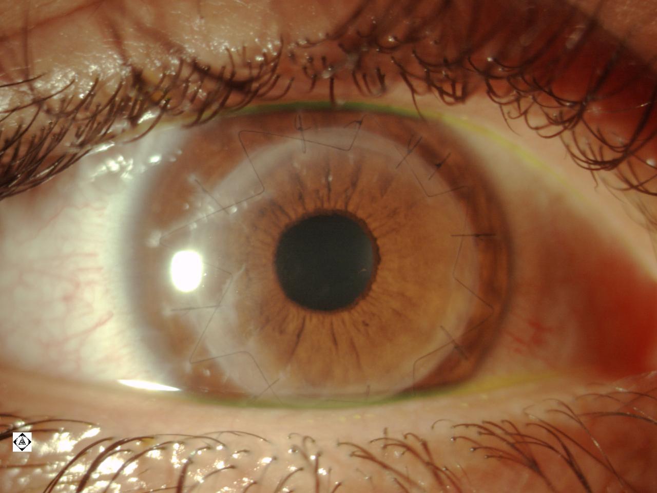 Sonoran Desert Eye Center: CORNEAL TRANSPLANT