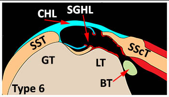 MRI Musculo-Skeletal Section: Long head of biceps dislocation grading.